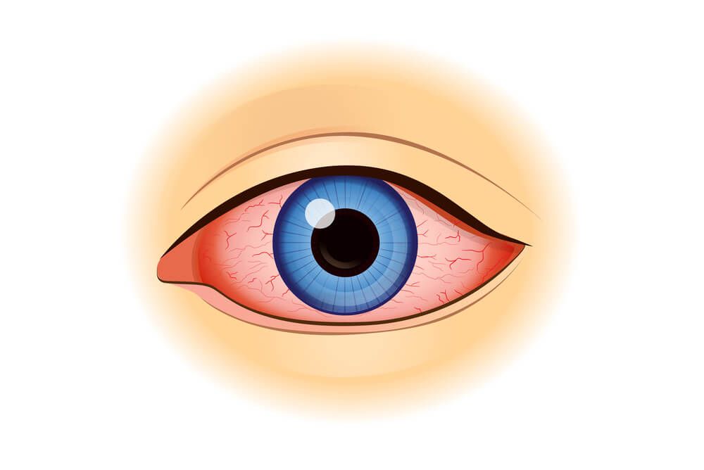 Red Eyeball Causes