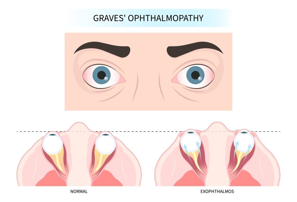 Understanding Exophthalmos: Key Causes and Effective Treatments