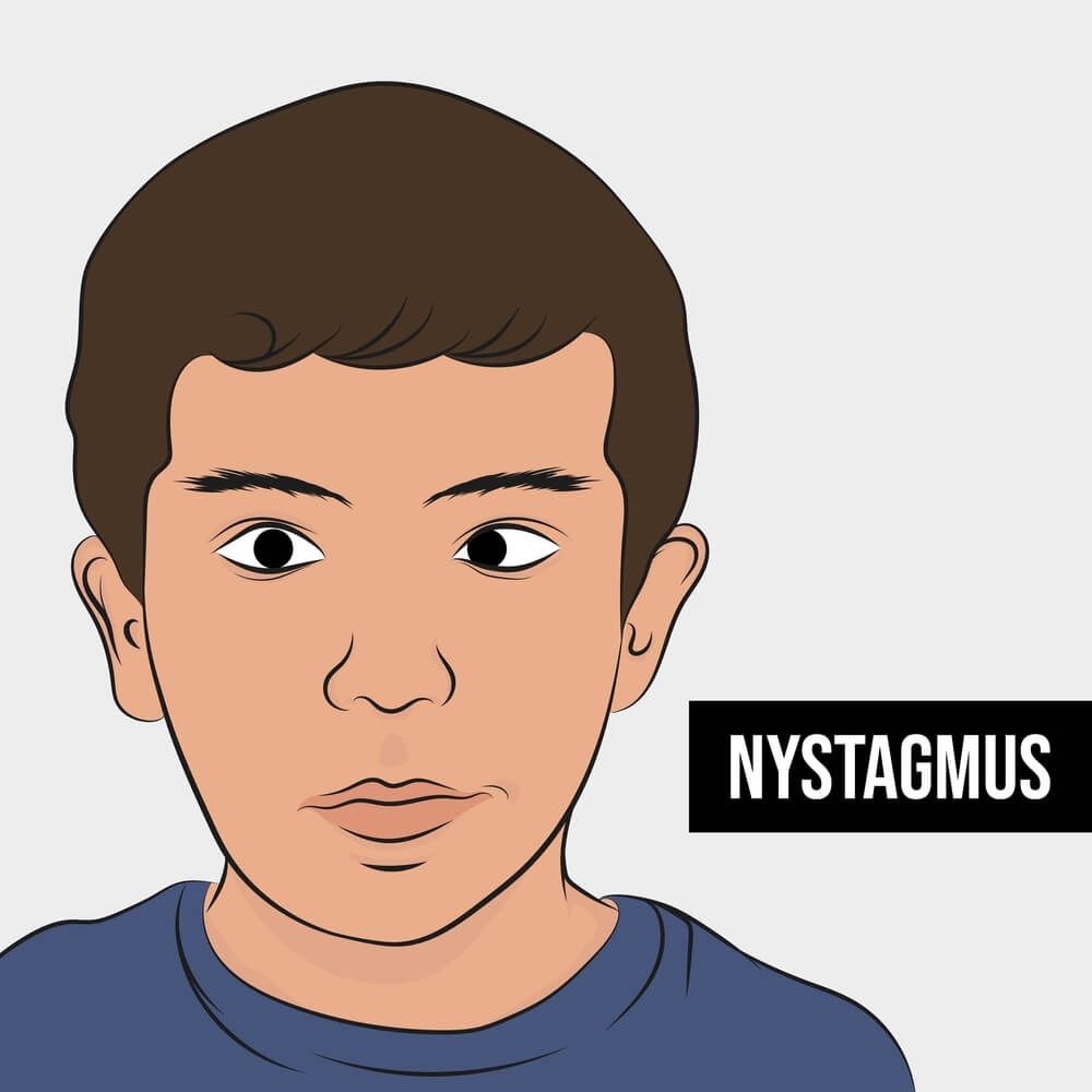 Nystagmus: Overview, Causes, Diagnosis, and Treatment