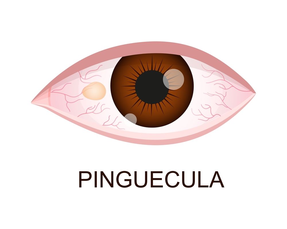 Top Causes, Home Treatments, and Surgery Costs for Pinguecula Eye