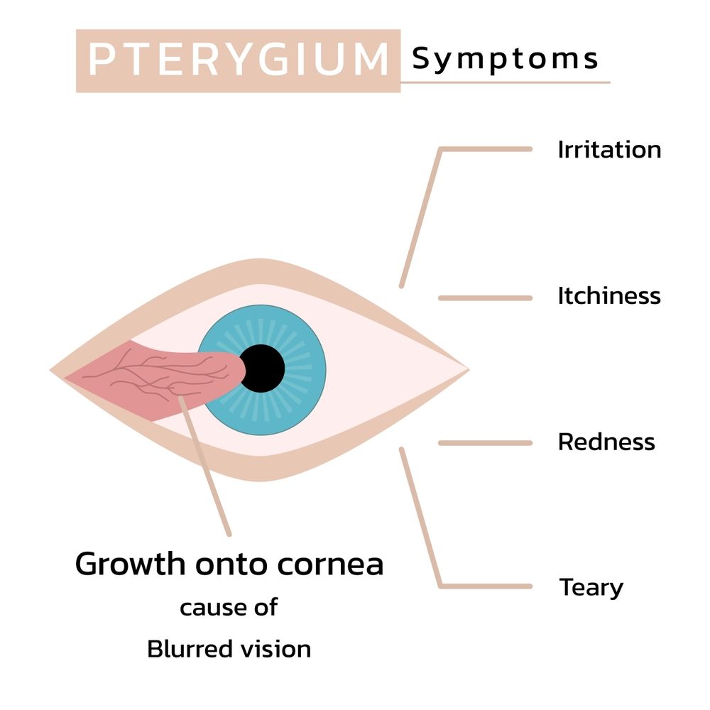 Differences, Causes, and Treatments for Pinguecula and Pterygium
