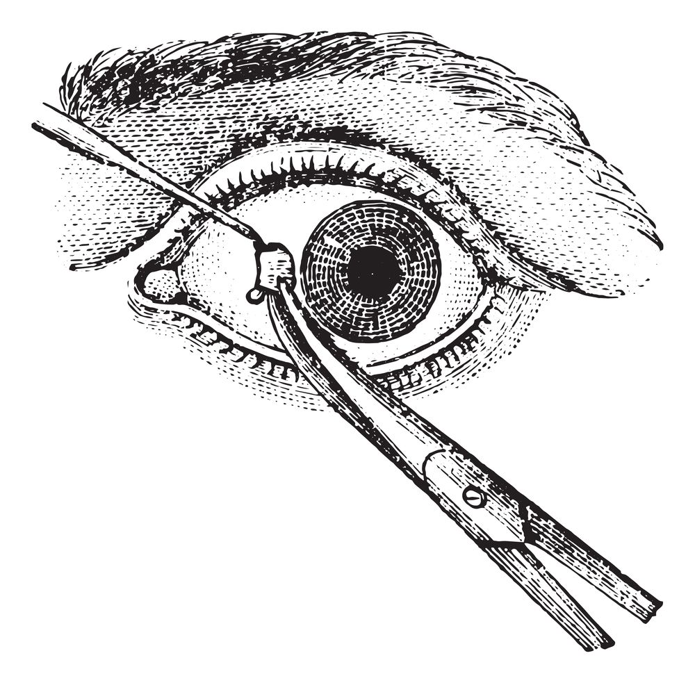 Differences, Causes, and Treatments for Pinguecula and Pterygium