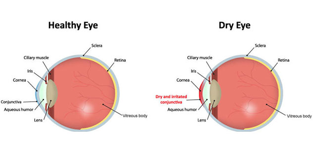 What is Dry Eye Syndrome? and How to Protect Yourself from Dry Eyes?